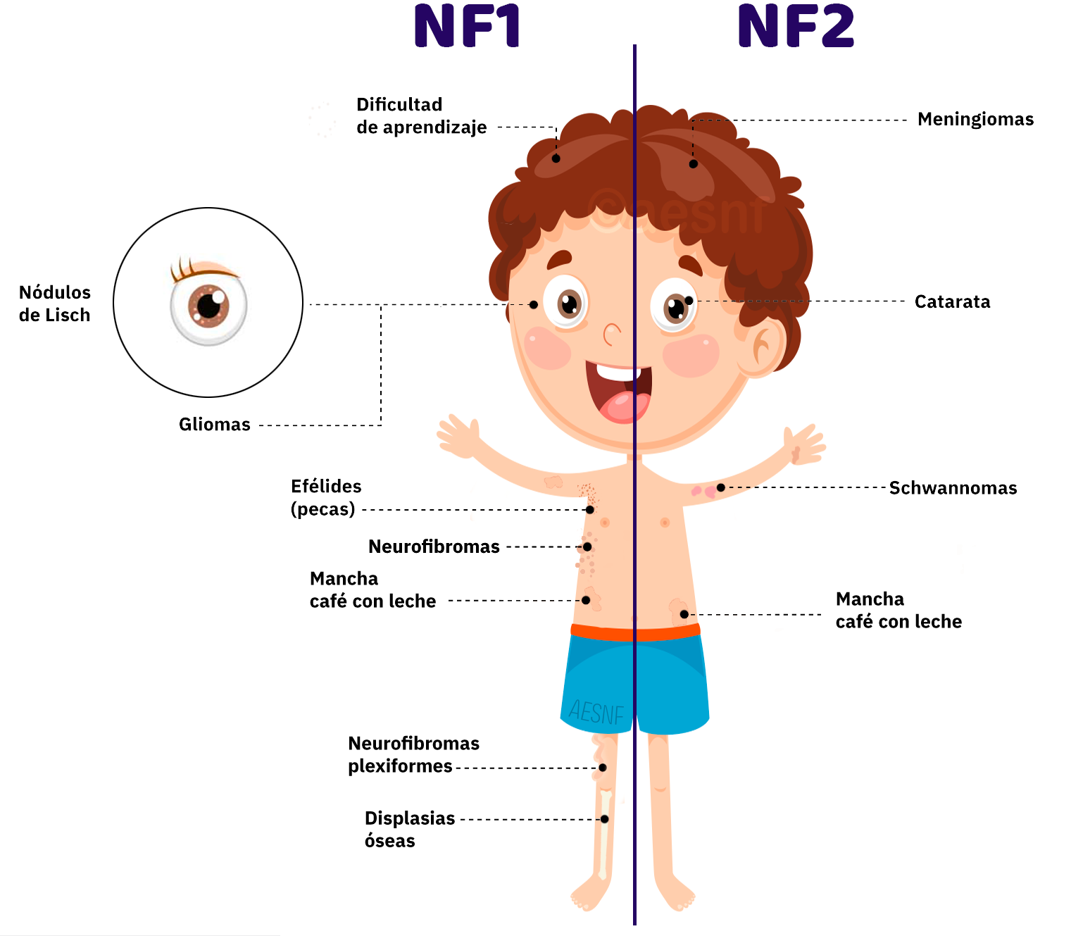 Diferencias entre tipos de Neurofibromatosis - Asociación Española de Neurofibromatosis
